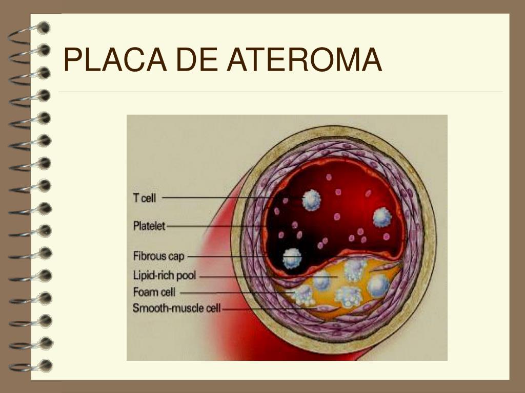 PPT - CARDIOPATÍA ISQUÉMICA CRÓNICA PowerPoint Presentation, free ...