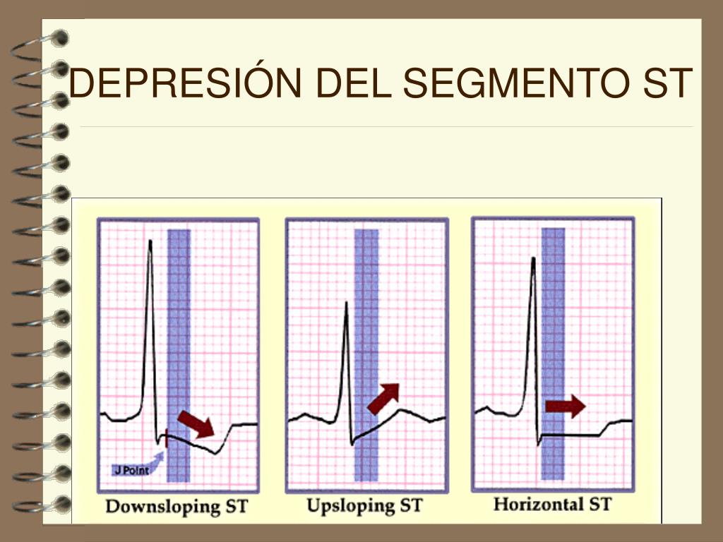 PPT - CARDIOPATÍA ISQUÉMICA CRÓNICA PowerPoint Presentation, free ...
