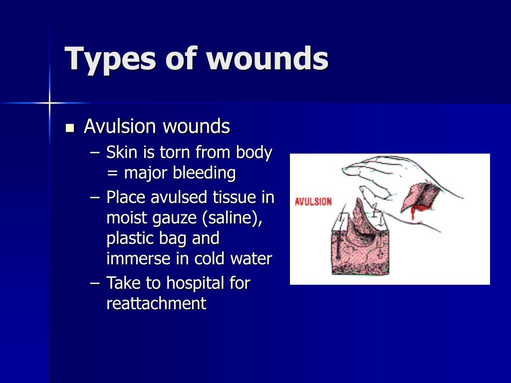 PPT - Wound Care PowerPoint Presentation, free download - ID:134758 PPT - Wound Care PowerPoint Presentation, free download - ID:134758