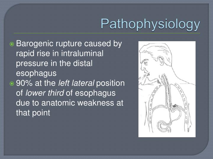 PPT - Management of Boerhaave's Syndrome PowerPoint Presentation - ID ...