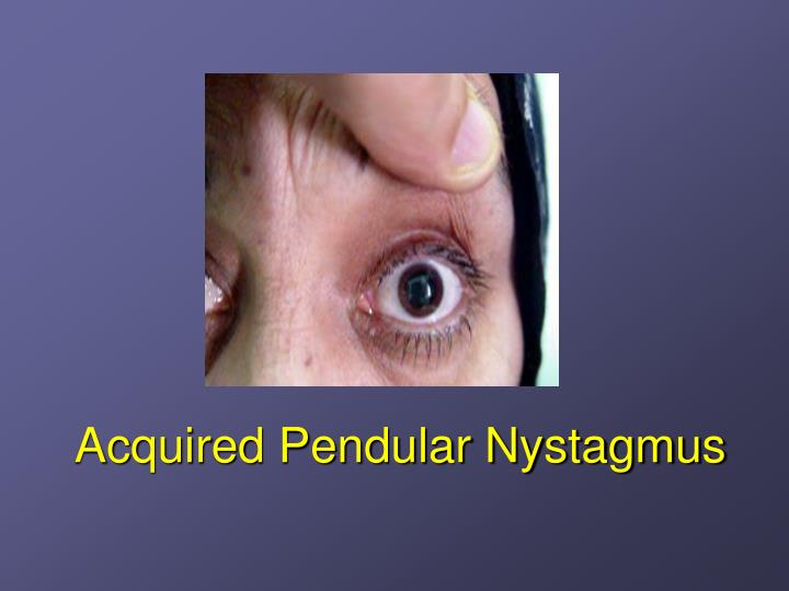 PPT - NYSTAGMUS PowerPoint Presentation - ID:1356516