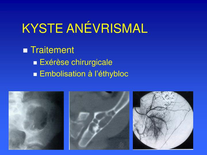 PPT - ASPECT RADIOLOGIQUE DU KYSTE ANEVRISMAL PowerPoint Presentation ...