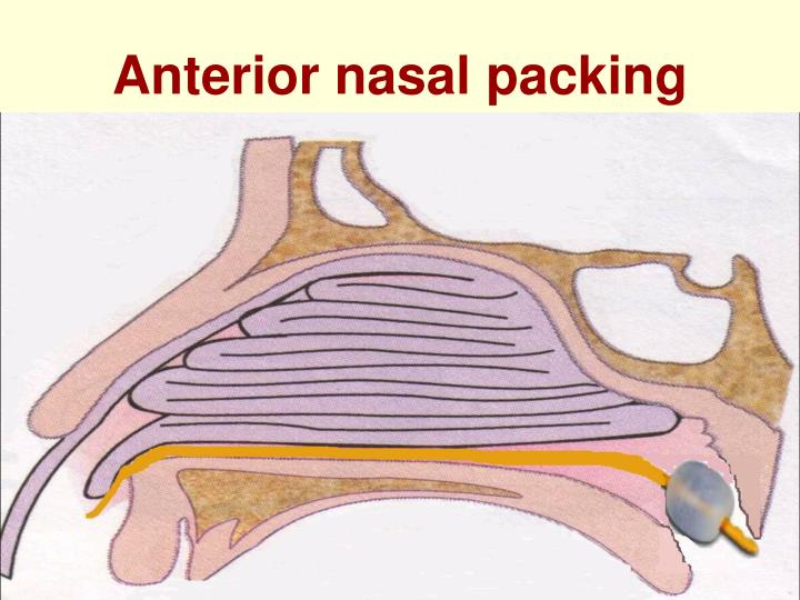 PPT - Epistaxis PowerPoint Presentation - ID:1364903