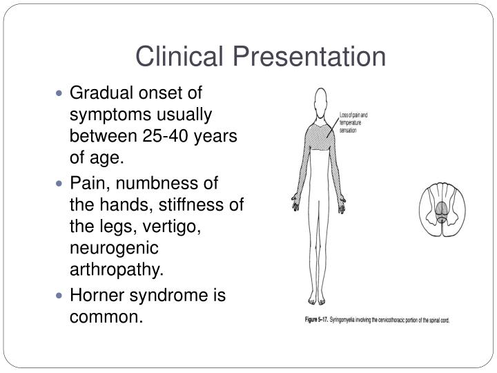 PPT - Syringomyelia PowerPoint Presentation - ID:1370411