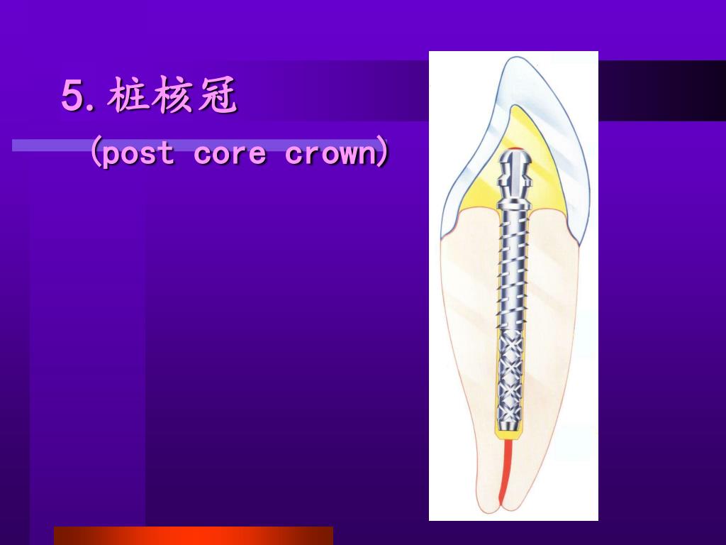 PPT - 牙体缺损的固定修复 固位原理 PowerPoint Presentation - ID:1377891