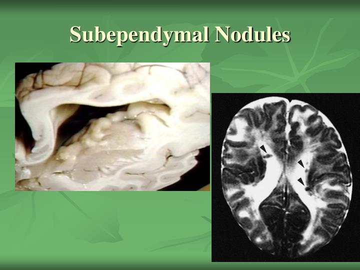 PPT - Angelman Syndrome, Rett Syndrome, and Tuberous Sclerosis ...