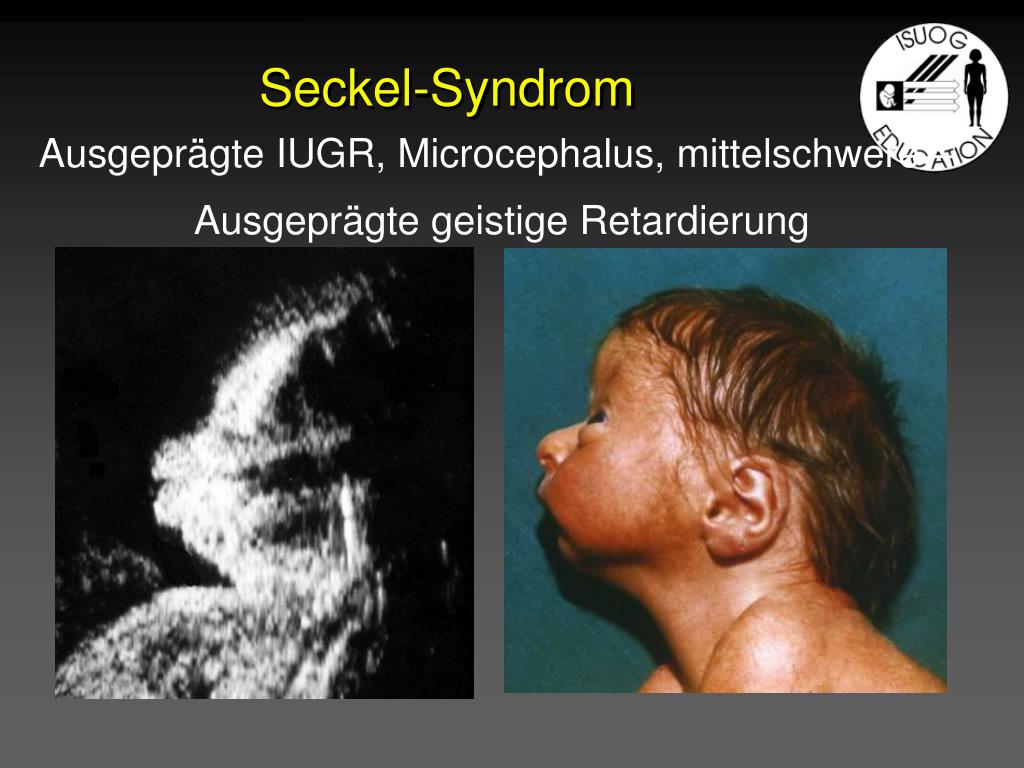 PPT - Fetal Syndromes in Prenatal Diagnosis - Challenges and Markers ...