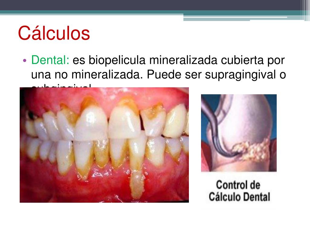 PPT - Microbiología de las enfermedades Gingivoperiodontales PowerPoint ...