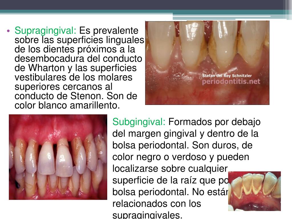 PPT - Microbiología de las enfermedades Gingivoperiodontales PowerPoint ...