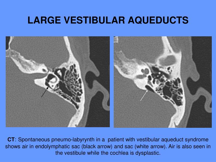 PPT - Congenital and Acquired Hearing Loss: a Review with Emphasis on ...