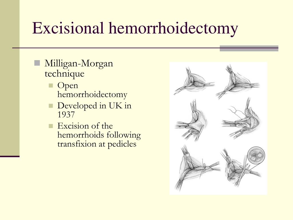 Ppt Updates On The Treatment Of Hemorrhoidal Disease Powerpoint