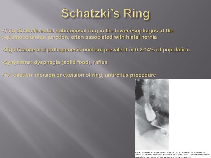 PPT - Esophagus and Diaphragmatic Hernia PowerPoint Presentation - ID ...