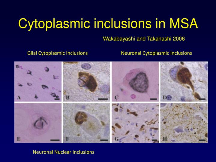 PPT - Sporadic ataxia and multiple system atrophy PowerPoint ...