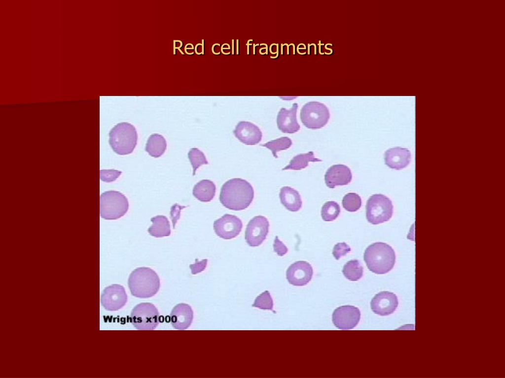 PPT - Thrombocytopenia Dr S W Bokhari Consultant Haematologist ...