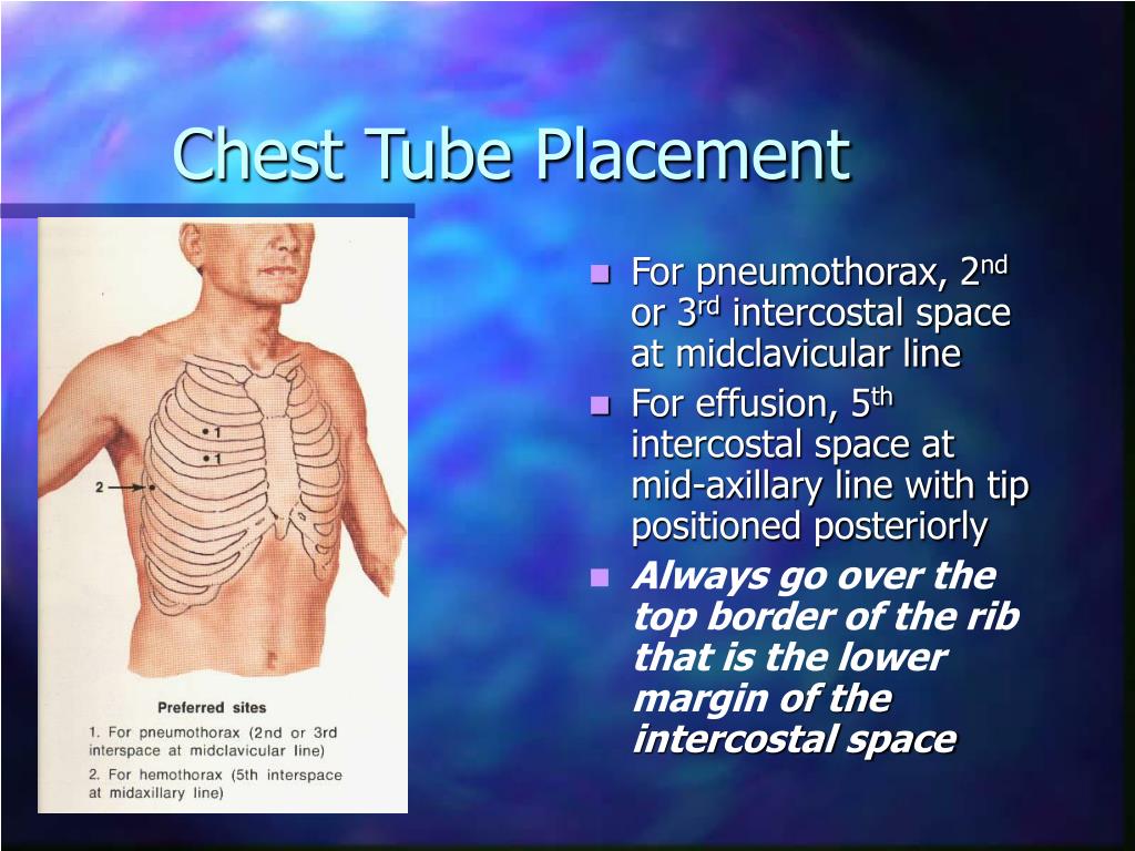 Correct Placement Of Chest Tube at Chantay Mccormick blog Correct Placement Of Chest Tube at Chantay Mccormick blog