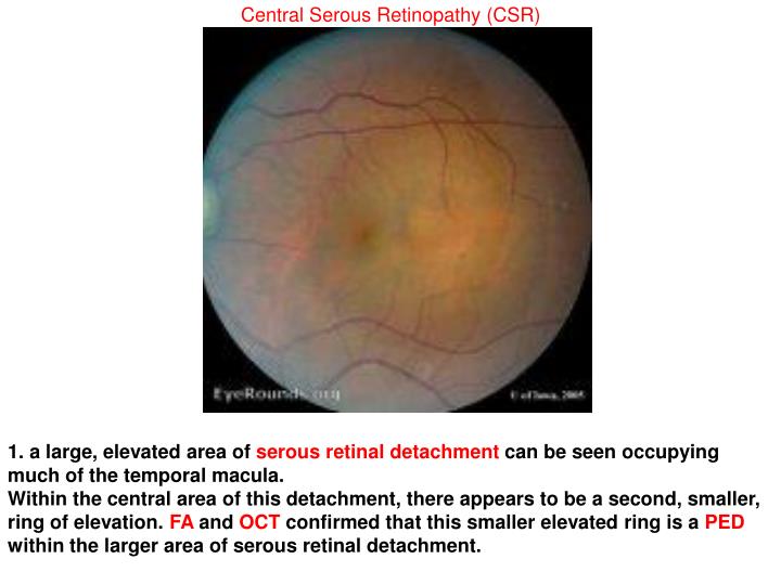 PPT - In the name of God Central serous chorioretinopathy PowerPoint ...