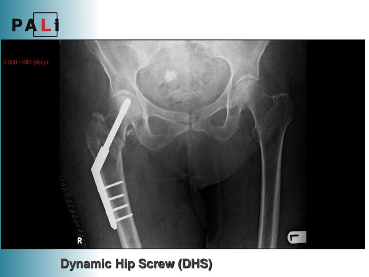 PPT - Hip Fractures PowerPoint Presentation - ID:1403265