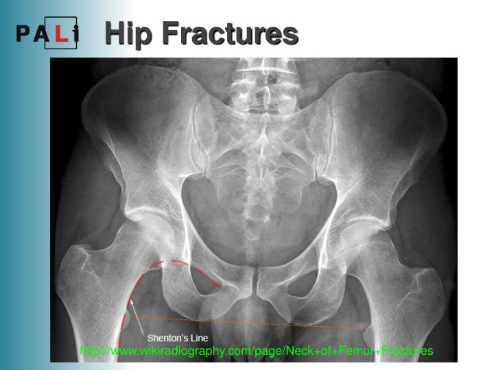 PPT - Hip Fractures PowerPoint Presentation - ID:1403265