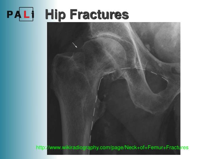 PPT - Hip Fractures PowerPoint Presentation - ID:1403265