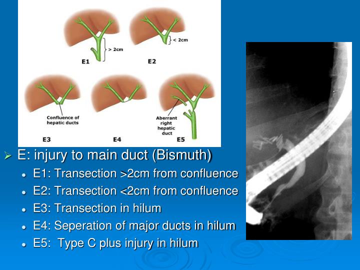 PPT - Complications During A Laparoscopic Cholecystectomy PowerPoint ...