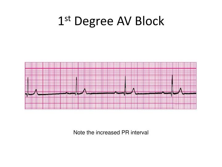 PPT - ACLS Rhythms Cheat Sheet PowerPoint Presentation - ID:1405583