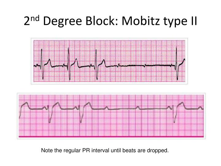 PPT - ACLS Rhythms Cheat Sheet PowerPoint Presentation - ID:1405583