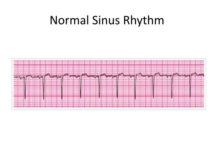 PPT - ACLS Rhythms Cheat Sheet PowerPoint Presentation - ID:1405583