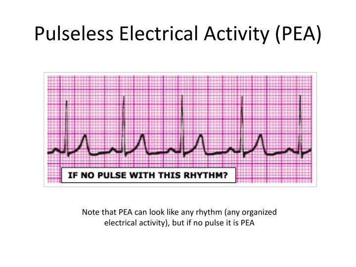 PPT - ACLS Rhythms Cheat Sheet PowerPoint Presentation - ID:1405583