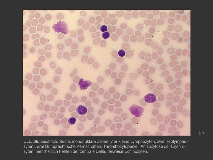 PPT - Chronische lymphatische Leukämie PowerPoint Presentation - ID:1405591