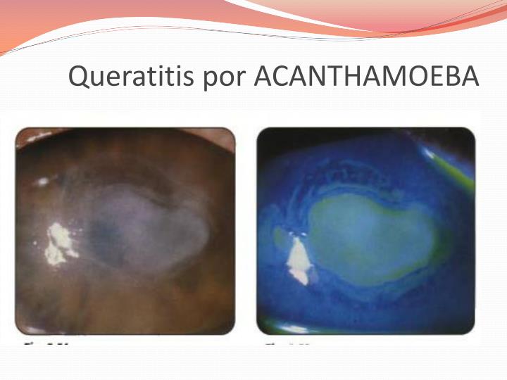 PPT - DIAGNOSTICO Y MANEJO DE QUERATITIS INFECCIOSA PowerPoint ...