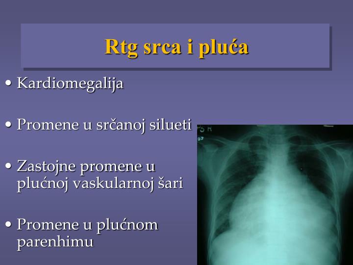PPT - Zloslutni prekordijalni bol kod dece i adolescenata PowerPoint ...