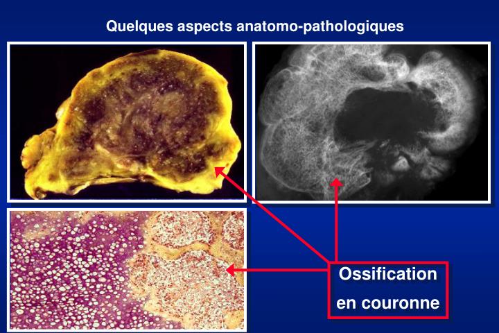 PPT - MYOSITE OSSIFIANTE NON TRAUMATIQUE PowerPoint Presentation - ID ...