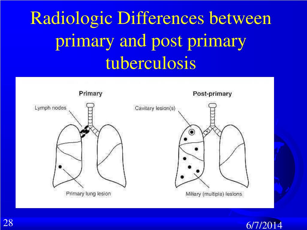 Tuberculosis Slide Tuberculosis Slide