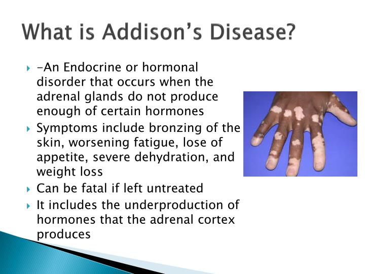 PPT - Addison’s Disease PowerPoint Presentation - ID:1412672