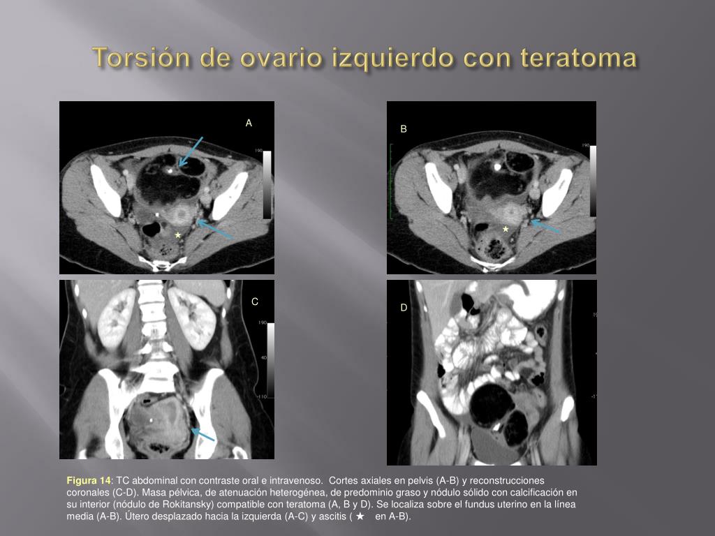 Ppt Torsión De Ovario Izquierdo Con Teratoma Powerpoint Presentation