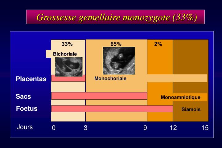PPT - Grossesse gémellaire PowerPoint Presentation - ID:1418539