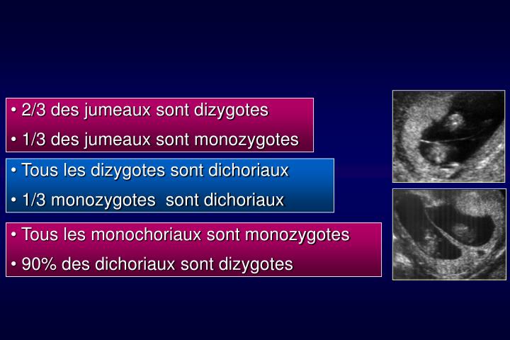 PPT - Grossesse gémellaire PowerPoint Presentation - ID:1418539
