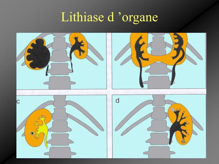 PPT - La lithiase rénale PowerPoint Presentation - ID:1419472