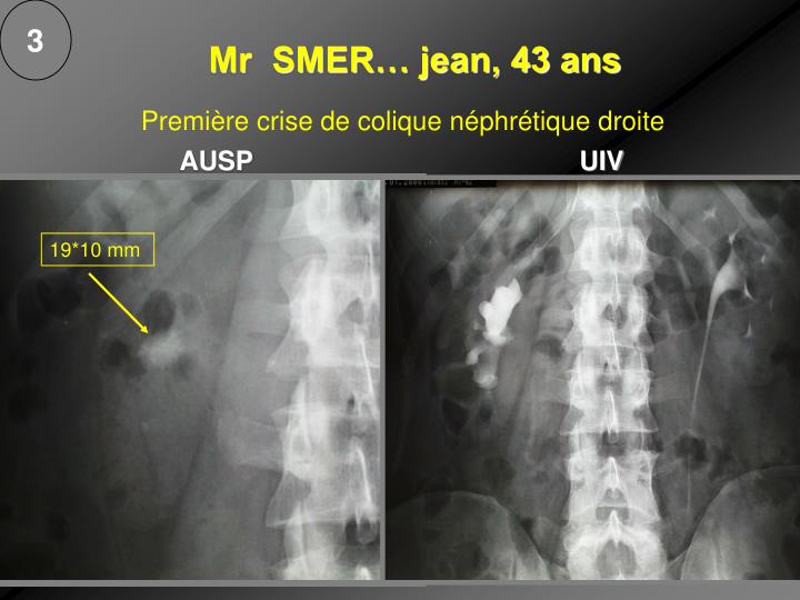 PPT - La lithiase rénale PowerPoint Presentation - ID:1419472