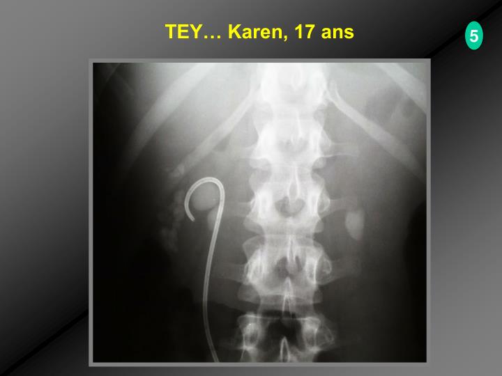 PPT - La lithiase rénale PowerPoint Presentation - ID:1419472