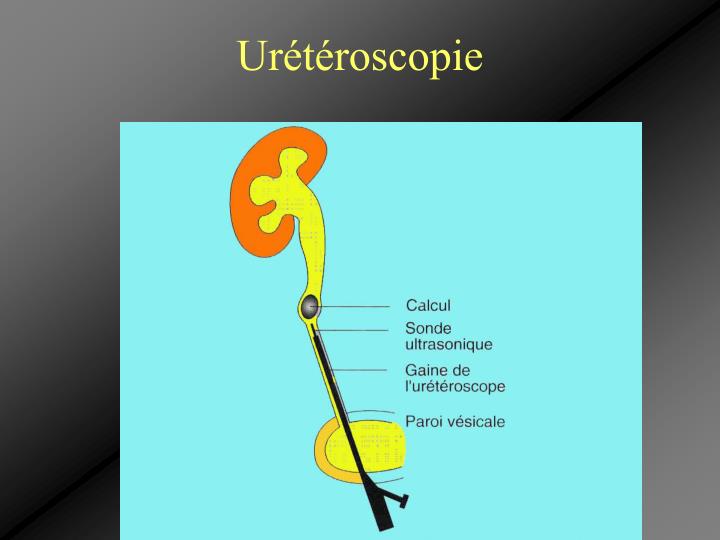 PPT - La lithiase rénale PowerPoint Presentation - ID:1419472