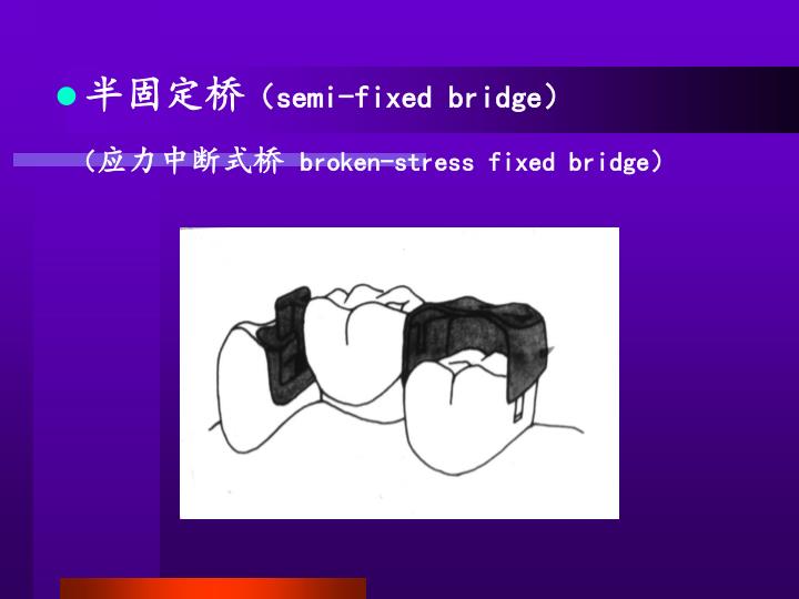 PPT - 第十三章 固定桥 Chapter four Fixed Partial Denture(Fixed bridge ...