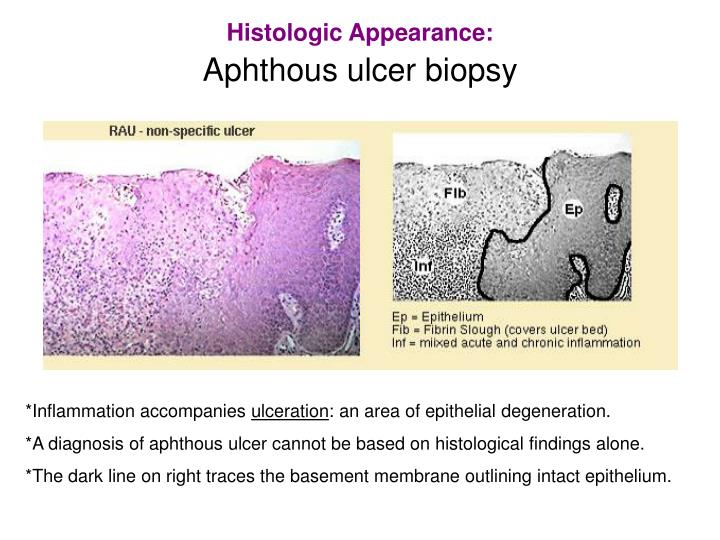 PPT - Oral Medicine Block Presentation: Aphthous Ulcers PowerPoint ...