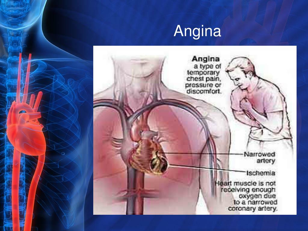 PPT STEMI PowerPoint Presentation Free Download ID 1423479