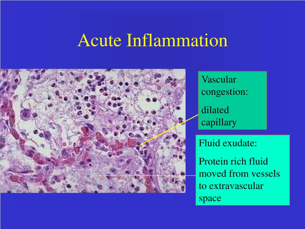 PPT Acute Inflammation PowerPoint Presentation Free Download ID