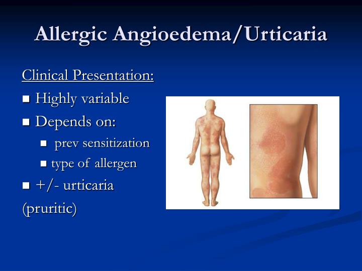 PPT - ANGIOEDEMA: Pathophysiology and Management PowerPoint ...