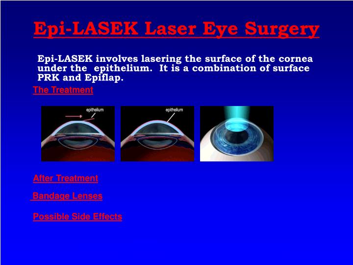 PPT - OCULAR LASER THERAPY PowerPoint Presentation - ID:1429683