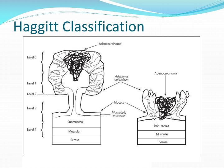 PPT - Treatment of Early Malignant Rectal Polyp PowerPoint Presentation ...