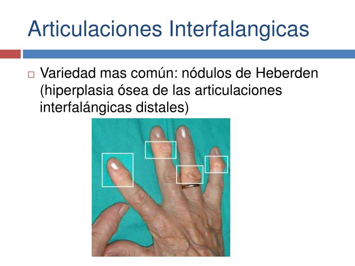 PPT - Osteoartritis PowerPoint Presentation - ID:1437861