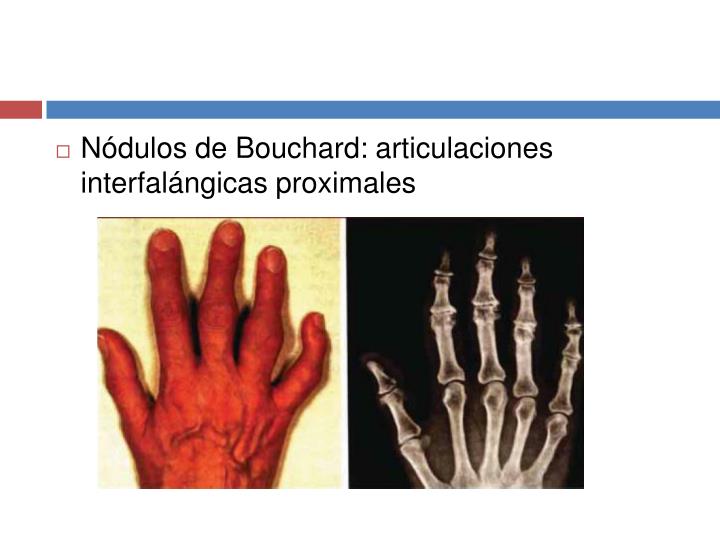 PPT - Osteoartritis PowerPoint Presentation - ID:1437861
